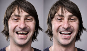 Smile-Vision | Before & After | Smile-Vision